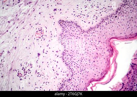 Photomicrographie du carcinome basocellulaire, montrant les cellules basales malignes typiques ...