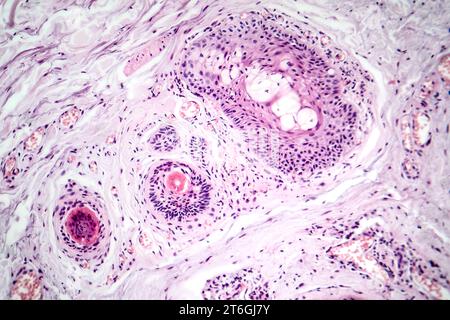 Photomicrographie du carcinome basocellulaire, montrant les cellules basales malignes typiques ...