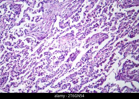 Photomicrographie de pneumonie lobaire en période de dissipation dissoute, montrant la ...