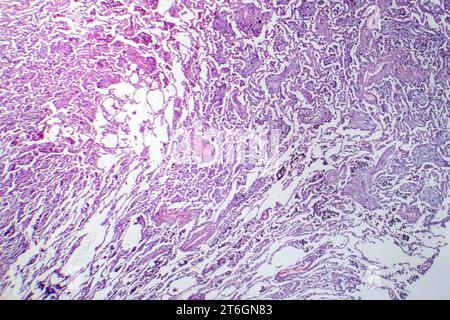 Photomicrographie de pneumonie lobaire en période de dissipation dissoute, montrant la ...