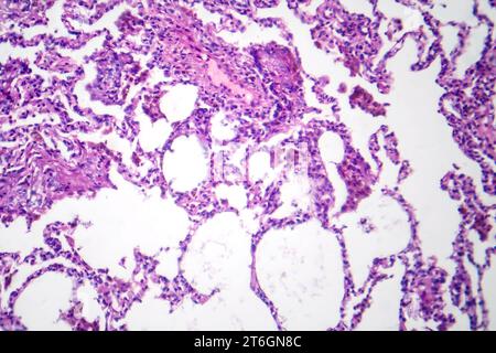 Photomicrographie de pneumonie lobaire en période de dissipation dissoute, montrant la ...