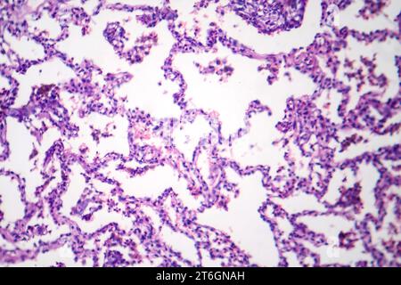 Photomicrographie de pneumonie lobaire en période de dissipation dissoute, montrant la ...