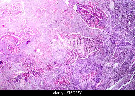 Photomicrographie d'un carcinome épidermoïde du poumon, montrant des cellules squameuses ...