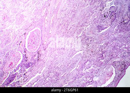 Photomicrographie d'un carcinome épidermoïde du poumon, montrant des cellules squameuses ...