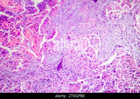 Photomicrographie d'un carcinome épidermoïde du poumon, montrant des cellules squameuses ...