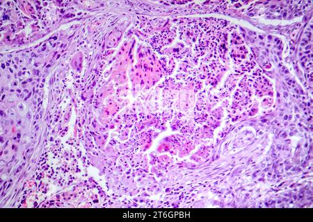 Photomicrographie d'un carcinome épidermoïde du poumon, montrant des cellules squameuses ...