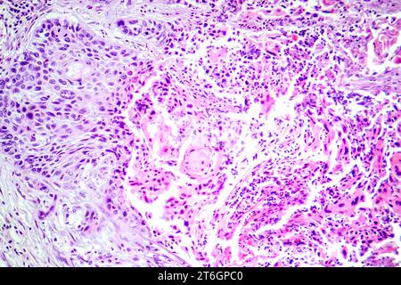 Photomicrographie d'un carcinome épidermoïde du poumon, montrant des cellules squameuses ...