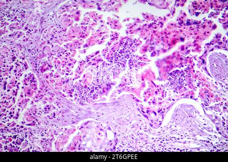 Photomicrographie d'un carcinome épidermoïde du poumon, montrant des cellules squameuses ...