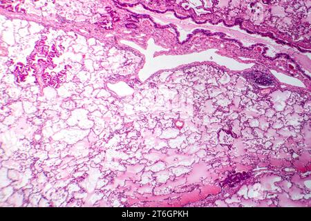 Photomicrographie d'adénocarcinome pulmonaire, montrant des cellules glandulaires malignes ...