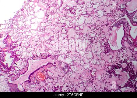 Photomicrographie d'adénocarcinome pulmonaire, montrant des cellules ...