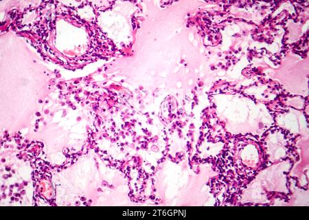 Photomicrographie d'adénocarcinome pulmonaire, montrant des cellules glandulaires malignes ...