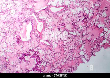 Photomicrographie d'adénocarcinome pulmonaire, montrant des cellules glandulaires malignes ...