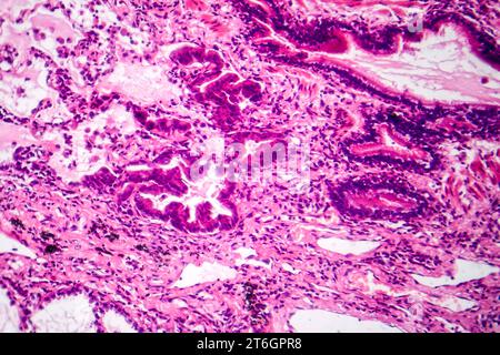 Photomicrographie d'adénocarcinome pulmonaire, montrant des cellules glandulaires malignes ...