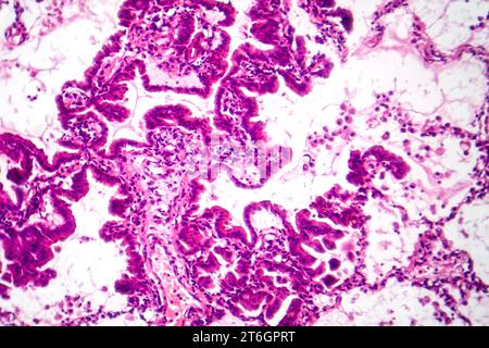 Photomicrographie d'adénocarcinome pulmonaire, montrant des cellules glandulaires malignes ...