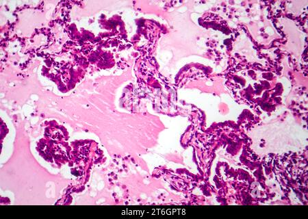 Photomicrographie d'adénocarcinome pulmonaire, montrant des cellules glandulaires malignes ...