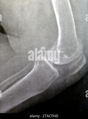 La radiographie simple du genou gauche montre une arthrose articulaire ...