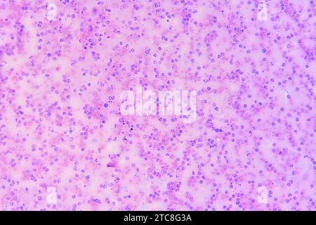 Les globules rouges infectés par le parasite du paludisme. Plasmodium ...