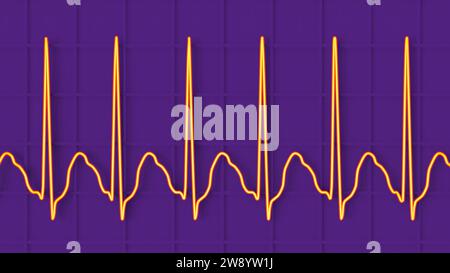 Illustration d'un électrocardiogramme (ECG) montrant une tachycardie ...