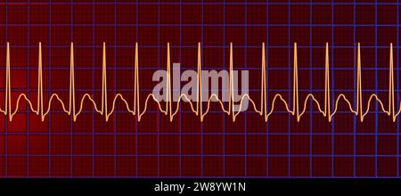Illustration d'un électrocardiogramme (ECG) montrant une tachycardie ...