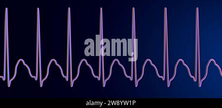 Illustration d'un électrocardiogramme (ECG) montrant une tachycardie ...
