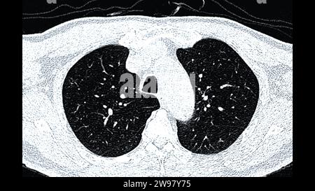Scanner CT de poitrine ou de poumon pour le dépistage des nodules ...