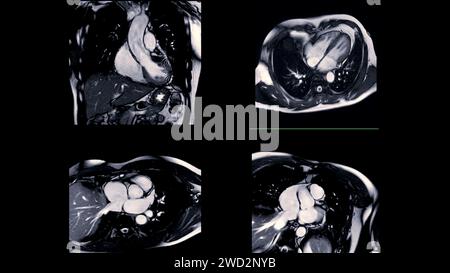 Les images IRM cardiaques sont essentielles pour évaluer la santé ...