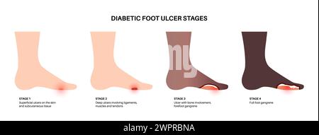 Stades du syndrome du pied diabétique, illustration. Ulcère profond ...