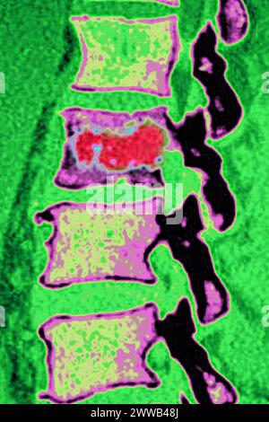 Ostéite vertébrale (inflammation du tissu osseux d'une vertèbre ...