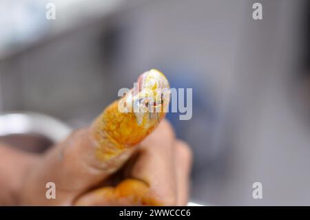 un pouce de la main gauche avec ablation chirurgicale de l'ongle du ...