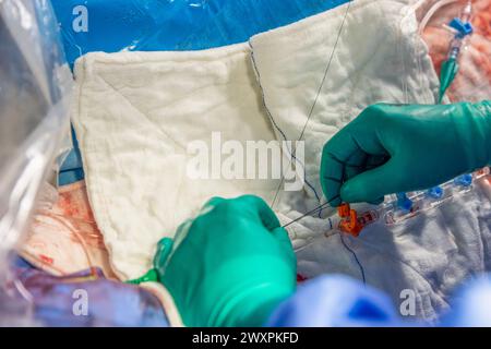 Procédé de mise en place d'un stent cardiaque en salle d'opération ...