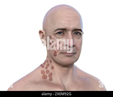 Illustration 3D d'un homme avec de multiples lésions du visage et du ...