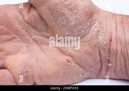 Eczéma des mains. Lésions, hémorragies, fissures, croûtes, écaillage ...