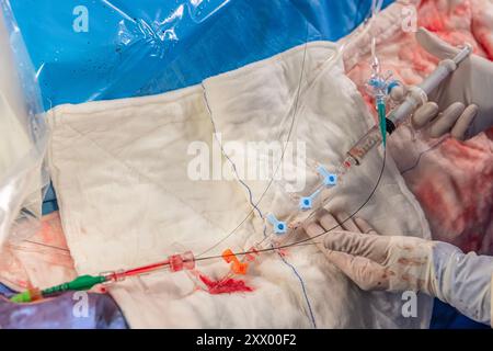 Procédé de mise en place d'un stent cardiaque en salle d'opération ...