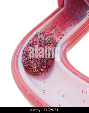 Illustration d'un caillot sanguin (thrombus) dans un vaisseau sanguin ...