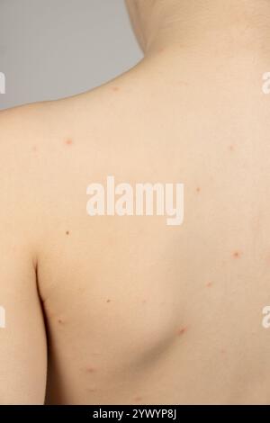 La peau d'un enfant atteint de varicelle, vésicules à différents stades ...