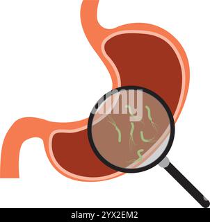 Maladies de l'estomac. Infection à Helicobacter pylori. Ulcère peptique ...