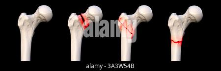 Illustration des types de fractures du fémur : fémur normal, fracture ...