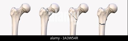 Illustration des types de fractures du fémur : fémur normal, fracture ...
