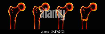 Illustration des types de fractures du fémur : fémur normal, fracture ...