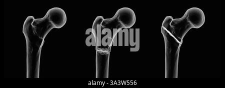 Illustration des types de fractures du fémur : fémur normal, fracture ...