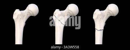 Illustration des types de fractures du fémur : fémur normal, fracture ...
