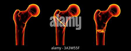 Illustration des types de fractures du fémur : fémur normal, fracture ...