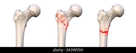 Illustration des types de fractures du fémur : fémur normal, fracture ...