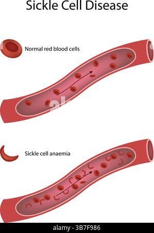 Globules rouges dans les vaisseaux sanguins, hémoglobine 3d vectorielle ...