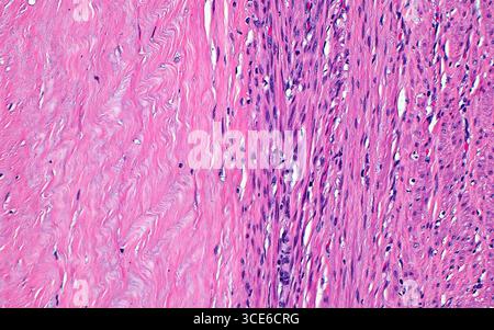Les fibromes utérins. La lumière microphotographie (LM) d'une section à ...