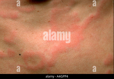 Une éruption cutanée, urticaire, réaction allergique de la peau Photo ...