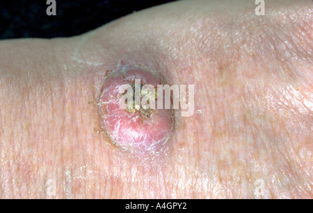 Le carcinome épidermoïde Photo Stock - Alamy