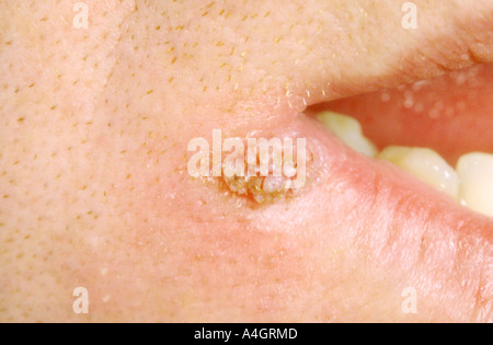 Une photographie de verrues communes (verruca vulgaris) sur les mains ...