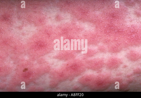 L'érythème polymorphe Photo Stock - Alamy