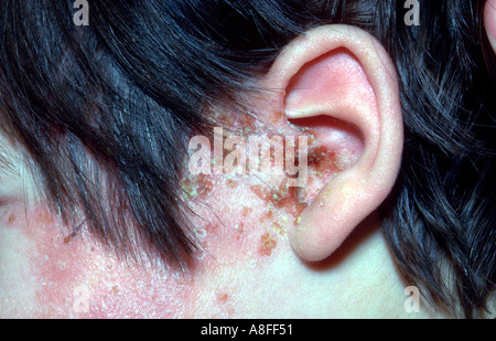 Zona zona éruption cutanée sur le visage Photo Stock - Alamy
